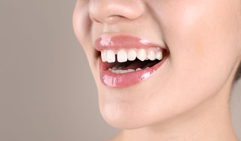 Fixing Teeth Spacing and Crowding: Invisalign’s Ultimate Solution